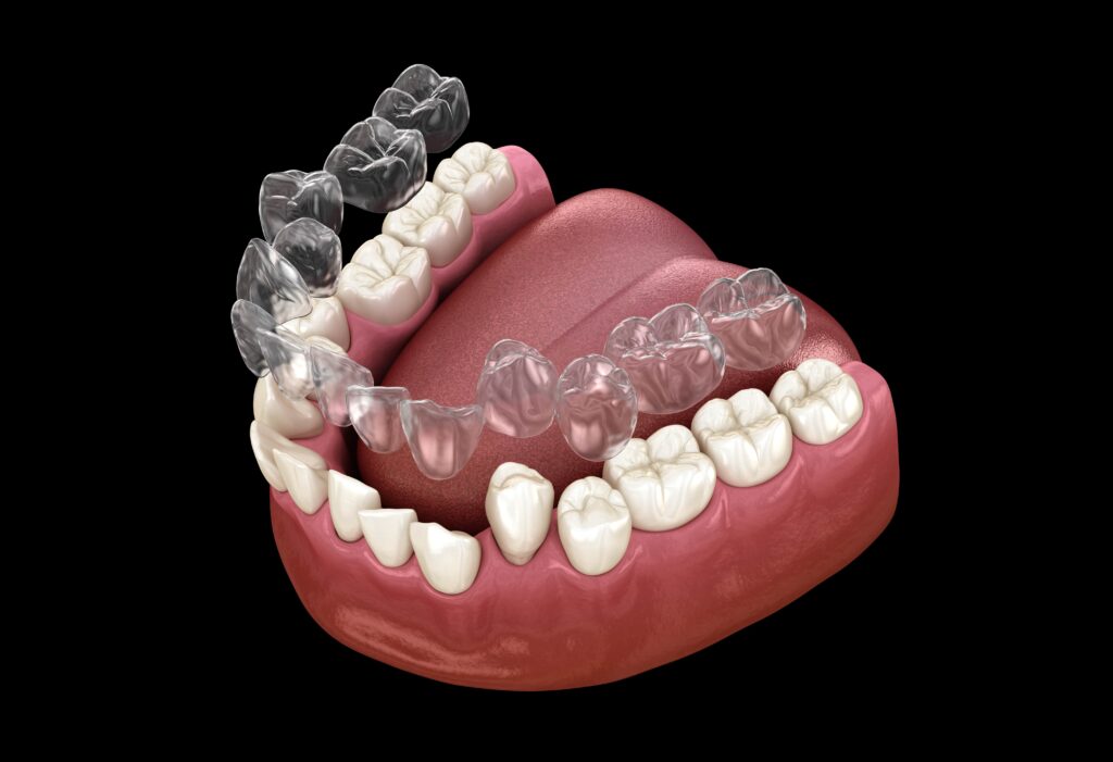 Using Invisalign for Orthodontic Retreatment: Enhancing Smiles with ...