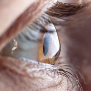 Dry Eye Therapy | Newcastle, WA | Coal Creek Family Vision