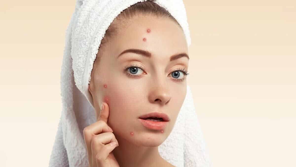 Acne on Face: Understanding & Treatment -Beauty Clinic in Toronto ...