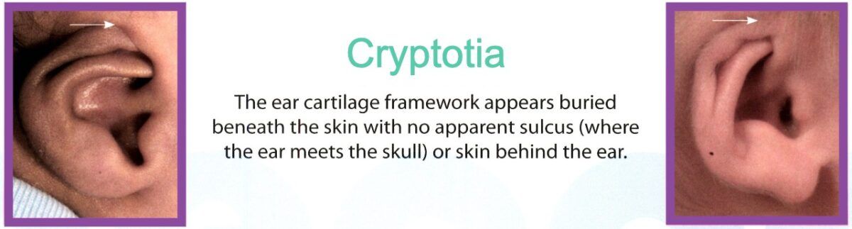 Cryptotia Ear Deformity | NYC and Trumbull, CT | Ears R Us