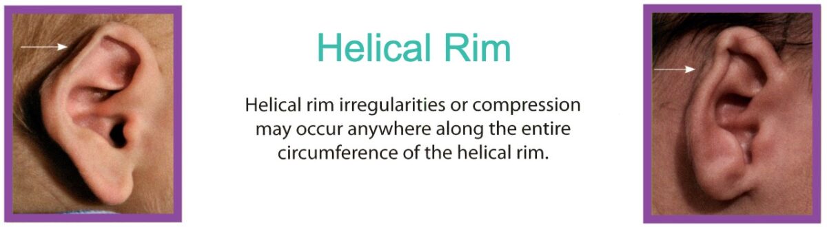 Helical Rim Deformity | Newborn Ear Molding in Connecticut and ...