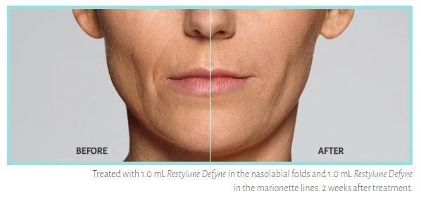 Restylane Products Lakeland Fl My Doctors Live Medispa