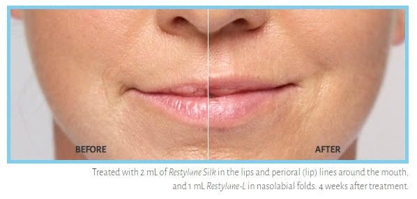 Restylane Products Lakeland Fl My Doctors Live Medispa