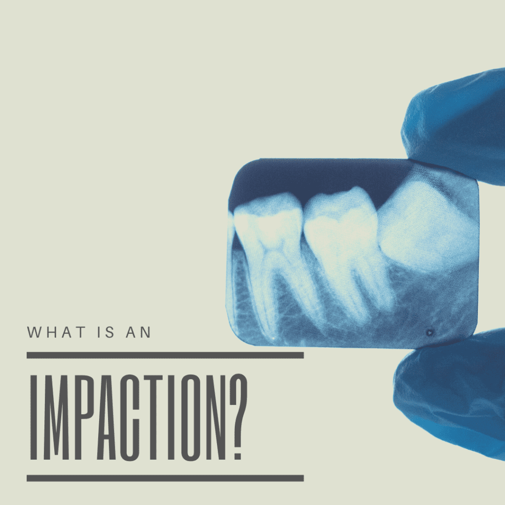 What Is An Impaction Cromwell Dentists Fedorciw Massoumi Kolbig