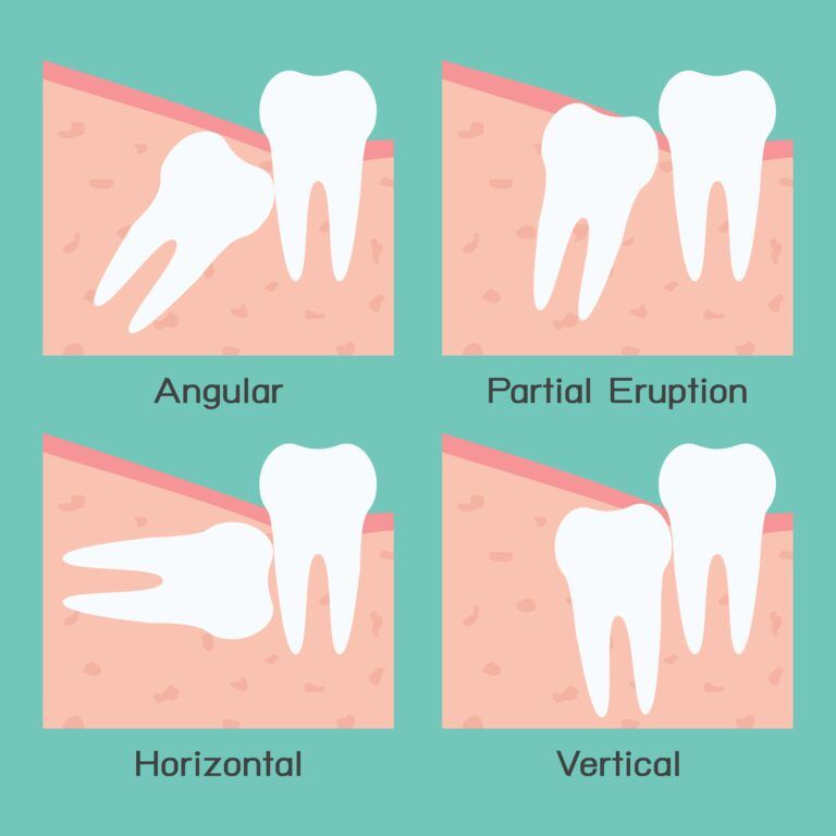 What is an Impaction? | Cromwell Dentists | Fedorciw, Massoumi & Kolbig