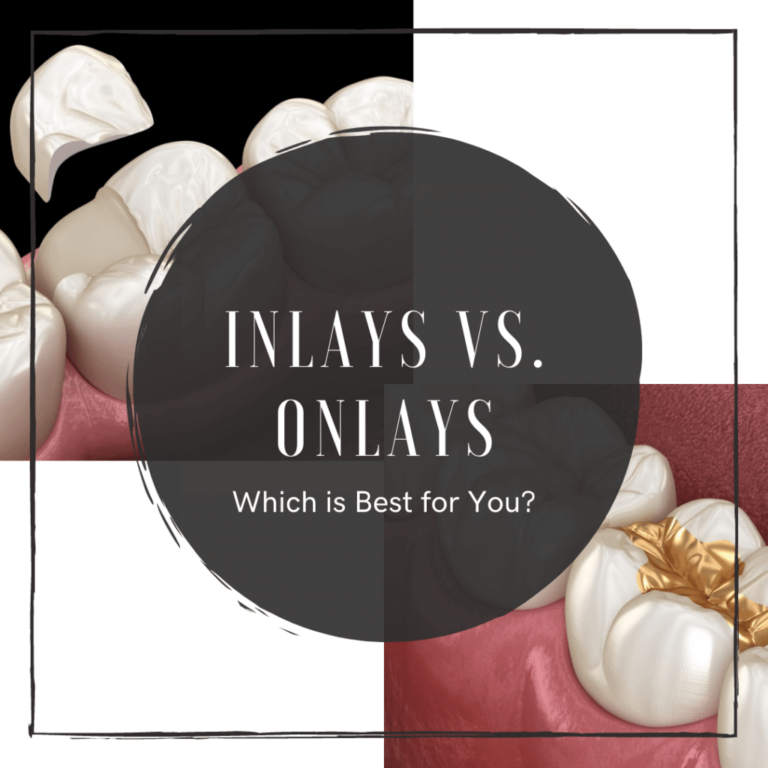 Inlays vs. Onlays: Which is Best for You? | Cromwell Dentists ...