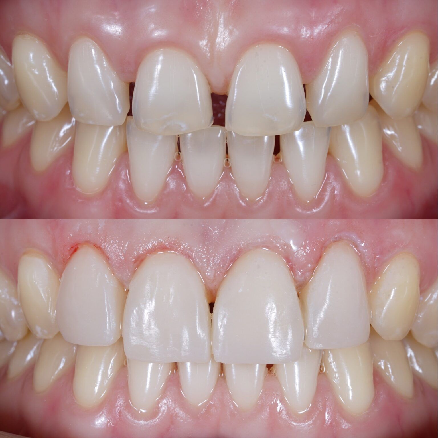 Closing the Gap: Understanding and Treating Spaces Between Teeth ...