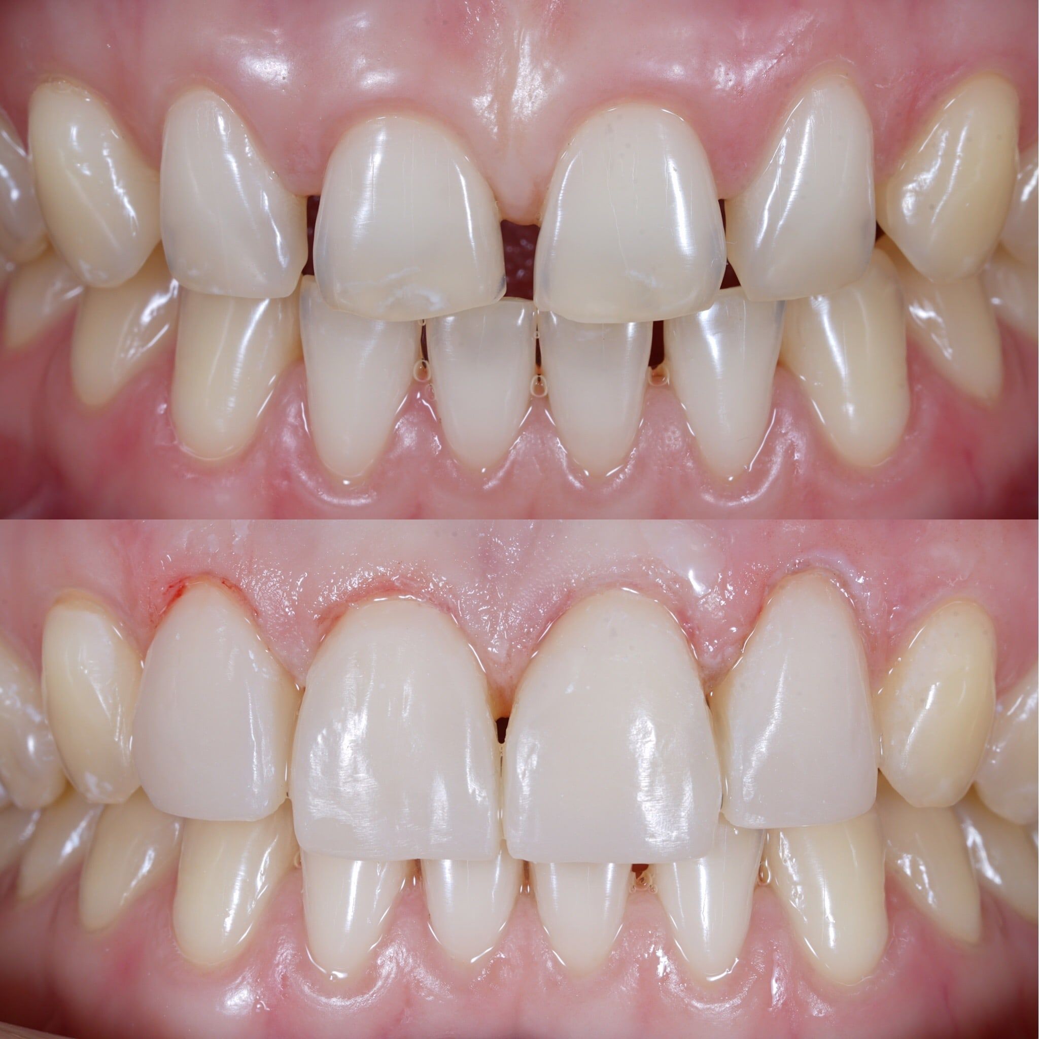 Closing the Gap: Understanding and Treating Spaces Between Teeth ...