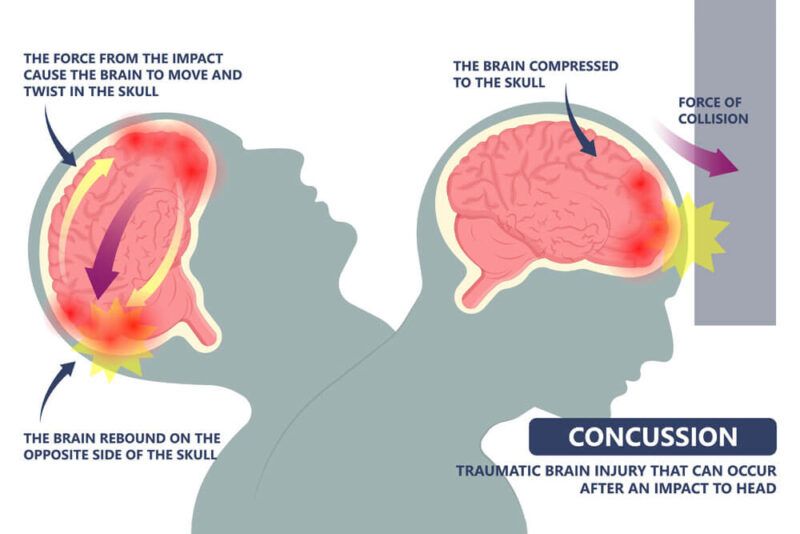 The Leading Concussion Clinic in Denver – Axon Integrative Health