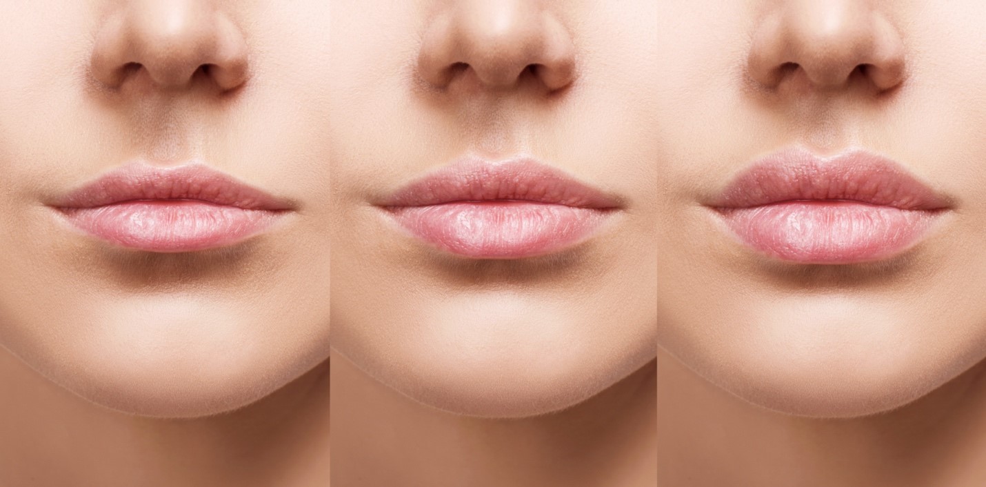 What size lip filler should I get? A Guide to the Perfect Pout
