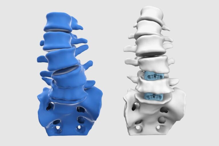Dr. Chan explains the benefits of personalized spine devices when ...