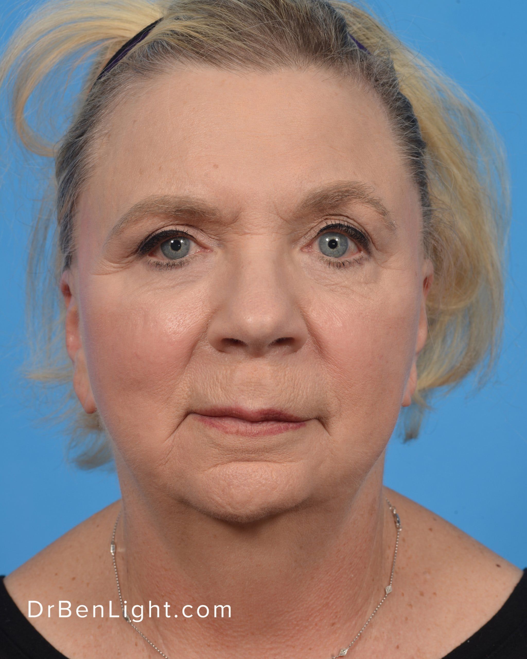 BodyTite - FaceTite - Accutite Archives - Dr. Ben Light