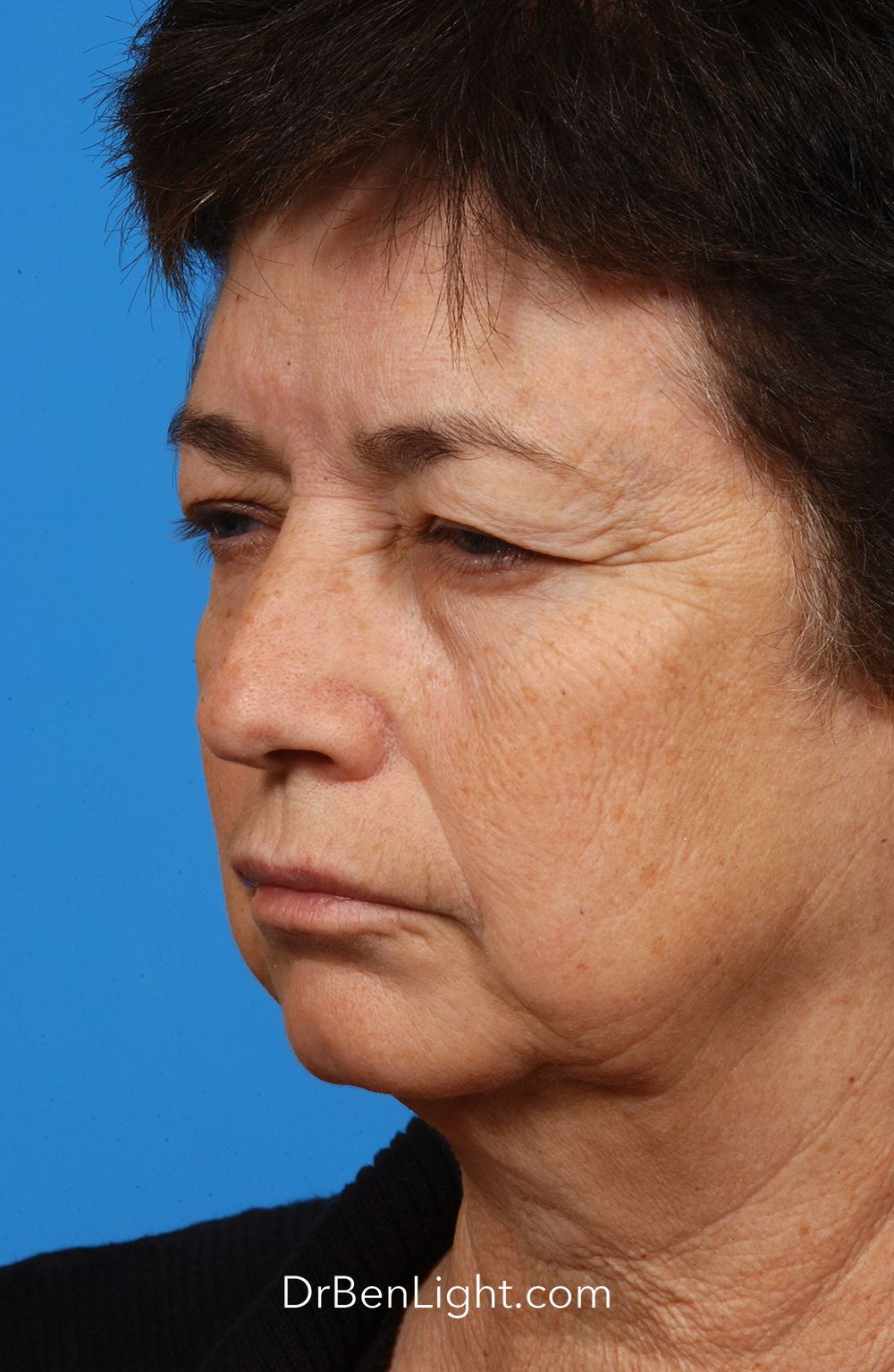 Facelift Archives - Dr. Ben Light