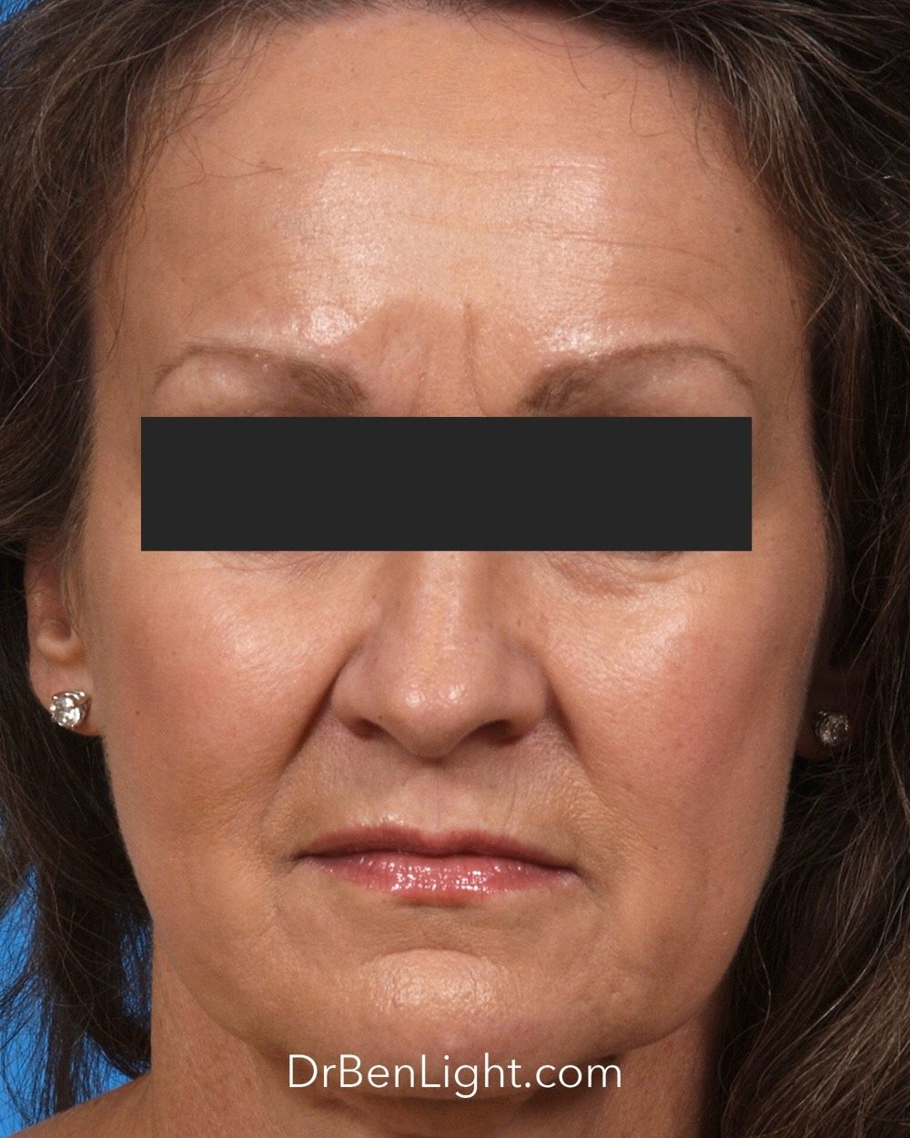 Facelift Archives - Dr. Ben Light