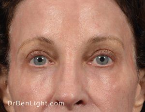 Blepharoplasty Droopy Eyelid Surgery - Tucson Dental Implants - Tucson, AZ