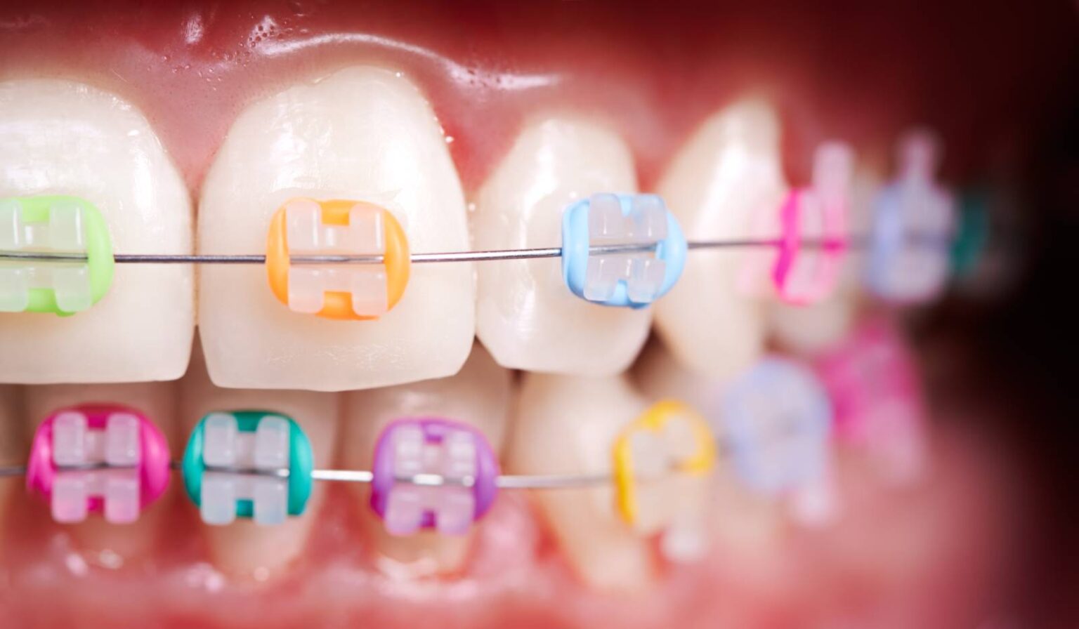 What Color Braces Should I Get? A Guide to Choosing the Best Braces ...