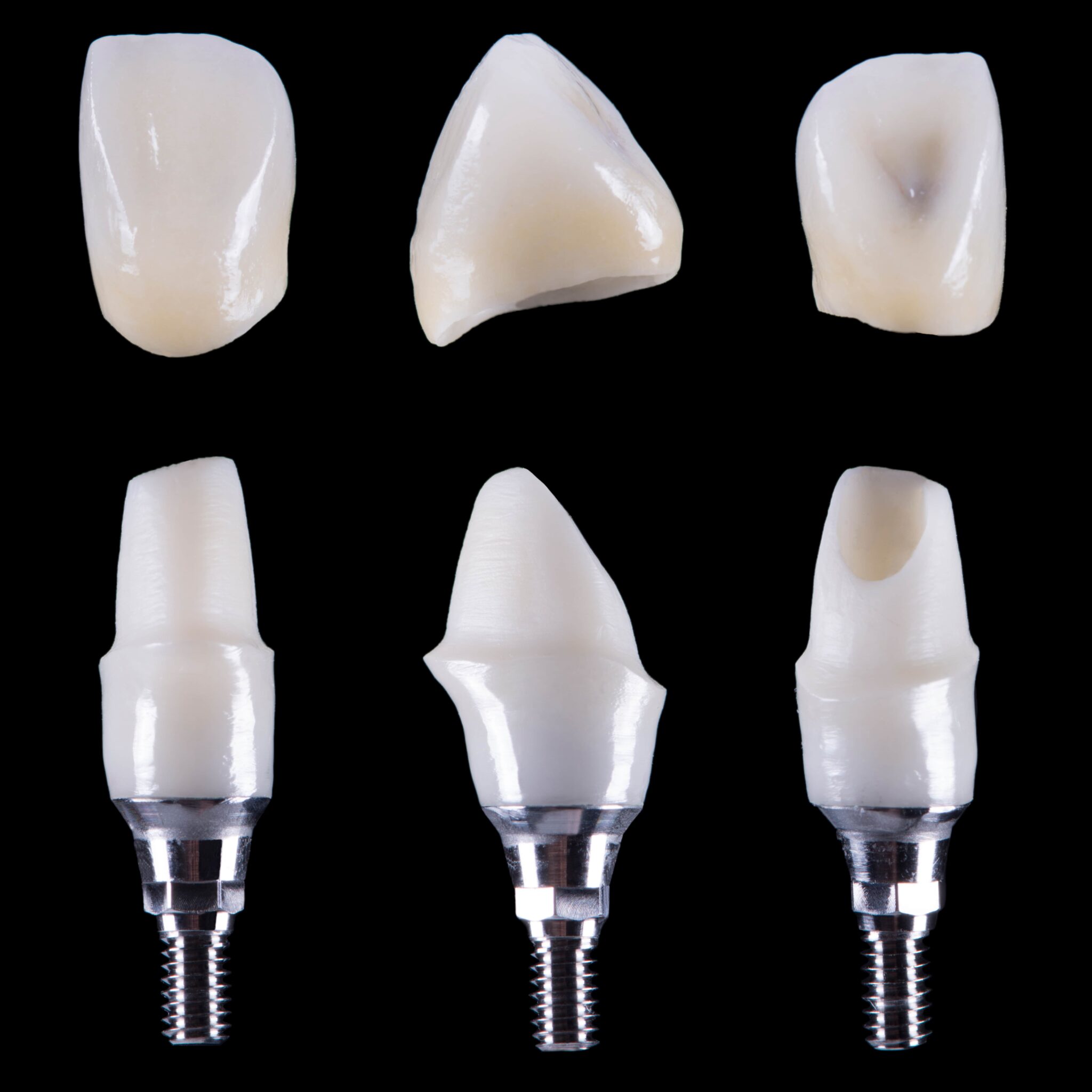 Customized Implant Abutments: Advantages | Savannah, GA and Houston, TX ...